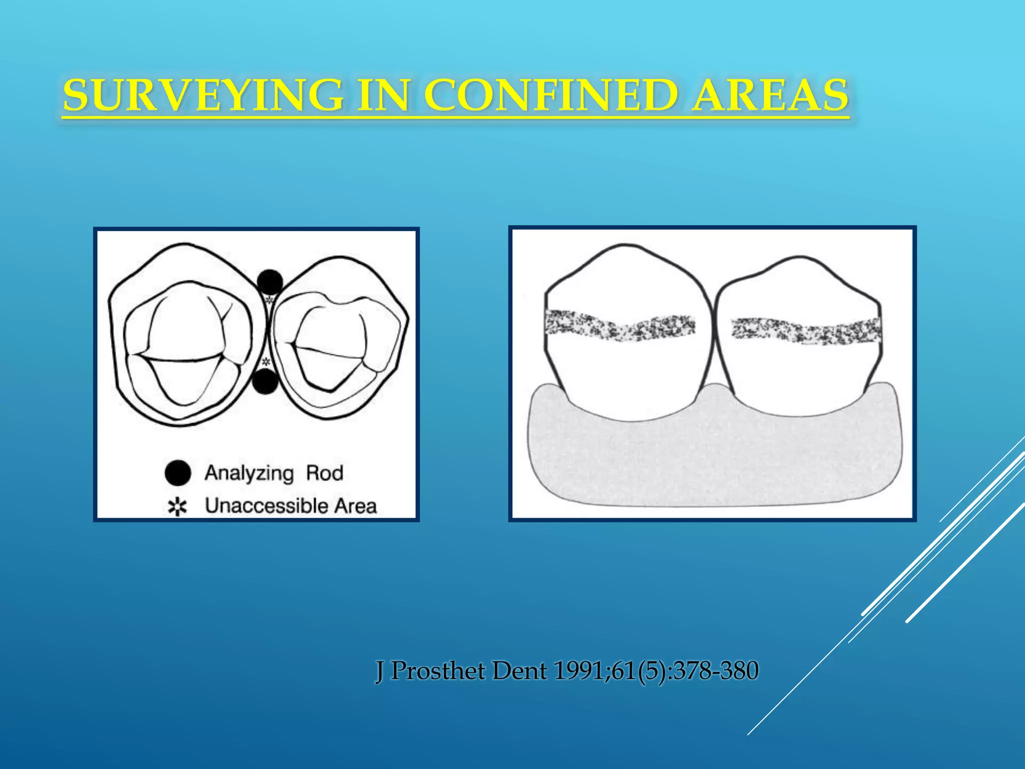 Surveyors and surveying in RPD | PPTX