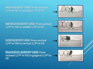 Surveyors and surveying in RPD | PPTX