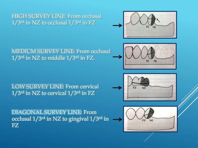 Surveyors and surveying in RPD | PPTX | Dental Health | Diseases and ...