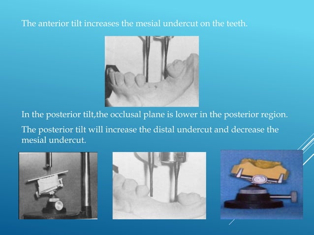 Surveyors and surveying in RPD | PPTX | Dental Health | Diseases and ...