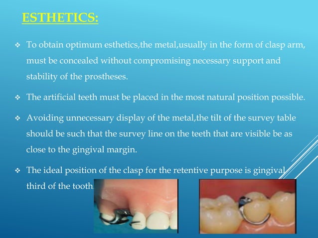 Surveyors and surveying in RPD | PPTX | Dental Health | Diseases and ...