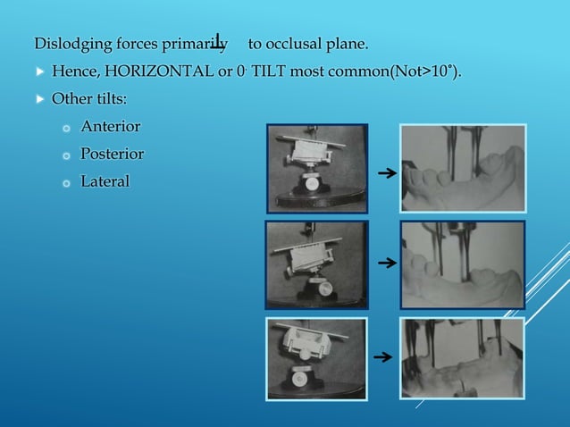 Surveyors and surveying in RPD | PPTX | Dental Health | Diseases and ...