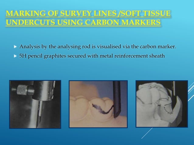 Surveyors and surveying in RPD | PPTX | Dental Health | Diseases and ...