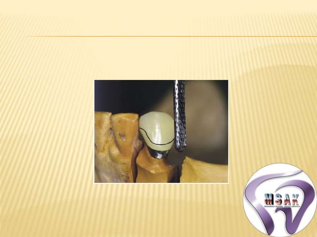 Surveying of cast for rpd | PPT