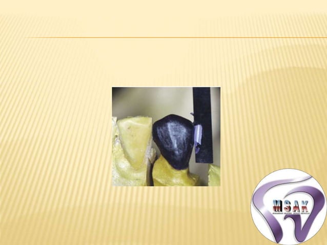 Surveying of cast for rpd | PPT