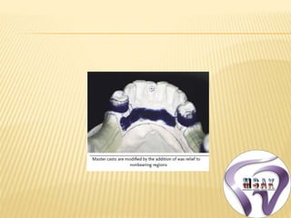 Surveying of cast for rpd | PPTX