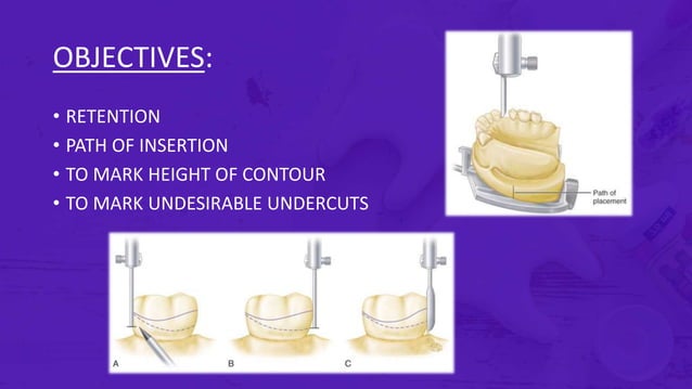 Surveying Tools. Prosthodontics 3rd year bds. Surveying. RPD ...