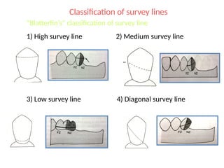 SURVEY LINES AND ITS SIGNIFICANCE IN DESIGNING DIRECT.pptx