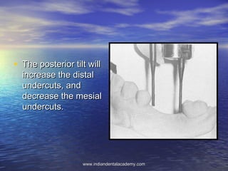 Surveyors & surveying in prosthodontics / dentistry dental implants | PPT