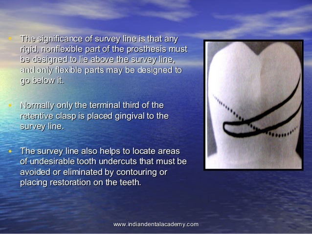 Surveyors & surveying in prosthodontics / dentistry dental implants