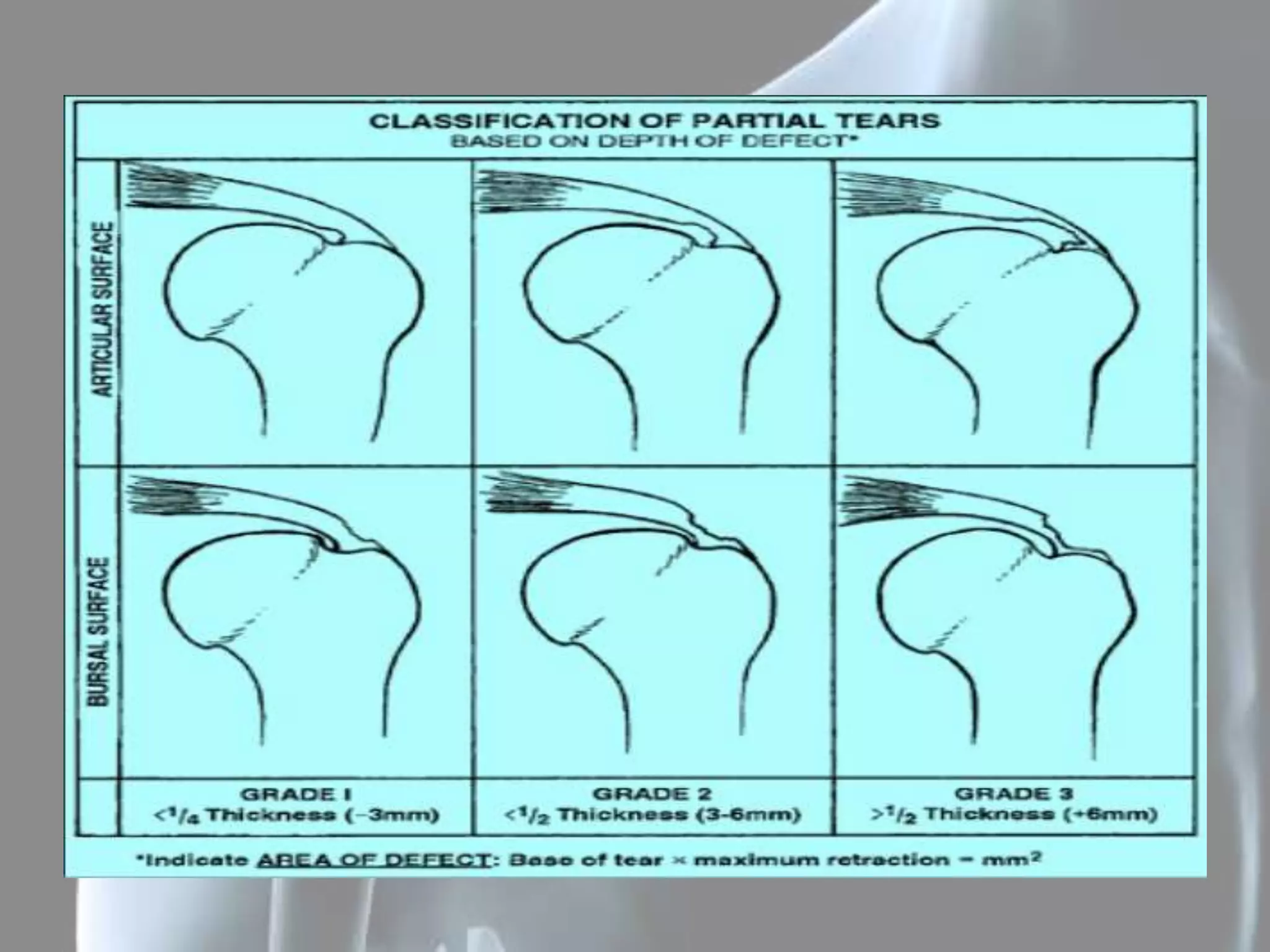 SHOULDER PATHOLOGIES IN YOUNG ACTIVE PERSONS | PPTX