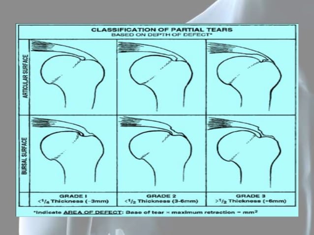 SHOULDER PATHOLOGIES IN YOUNG ACTIVE PERSONS | PPTX