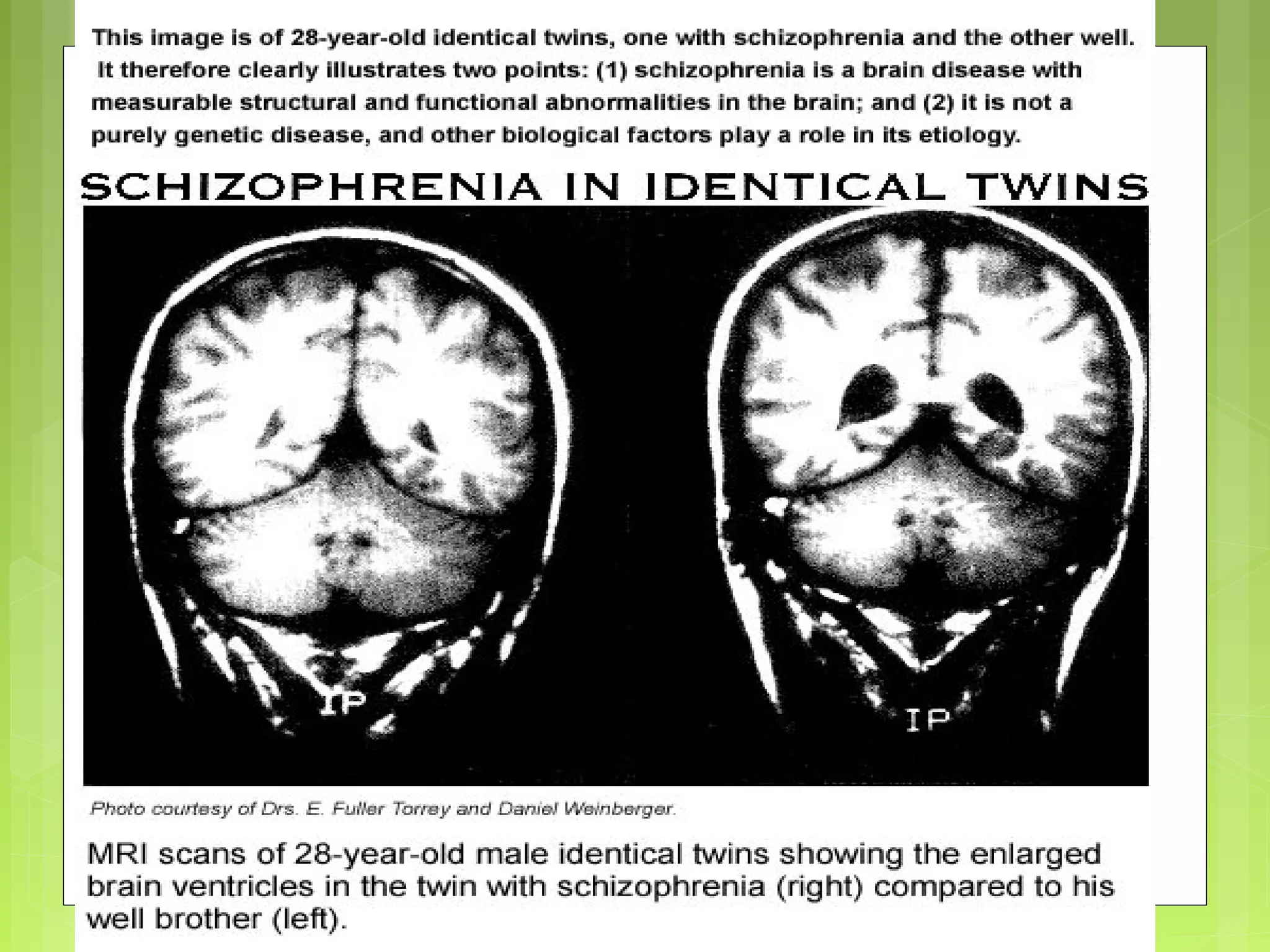 Schizophrenia; understanding and issues | PPT