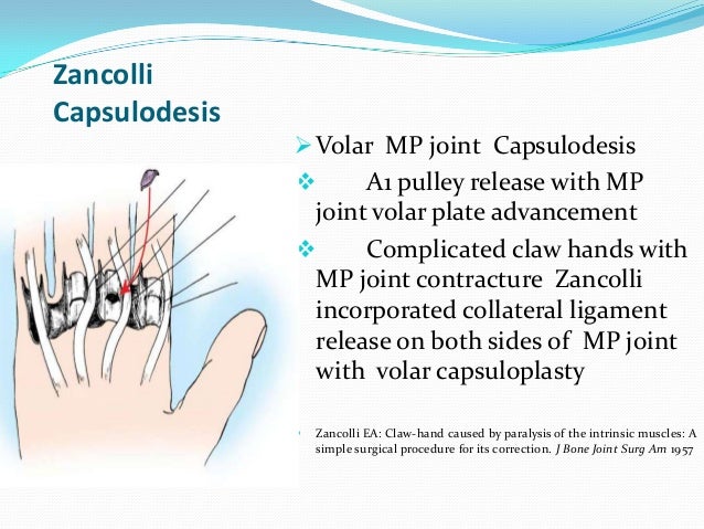 Susil seminar claw hand