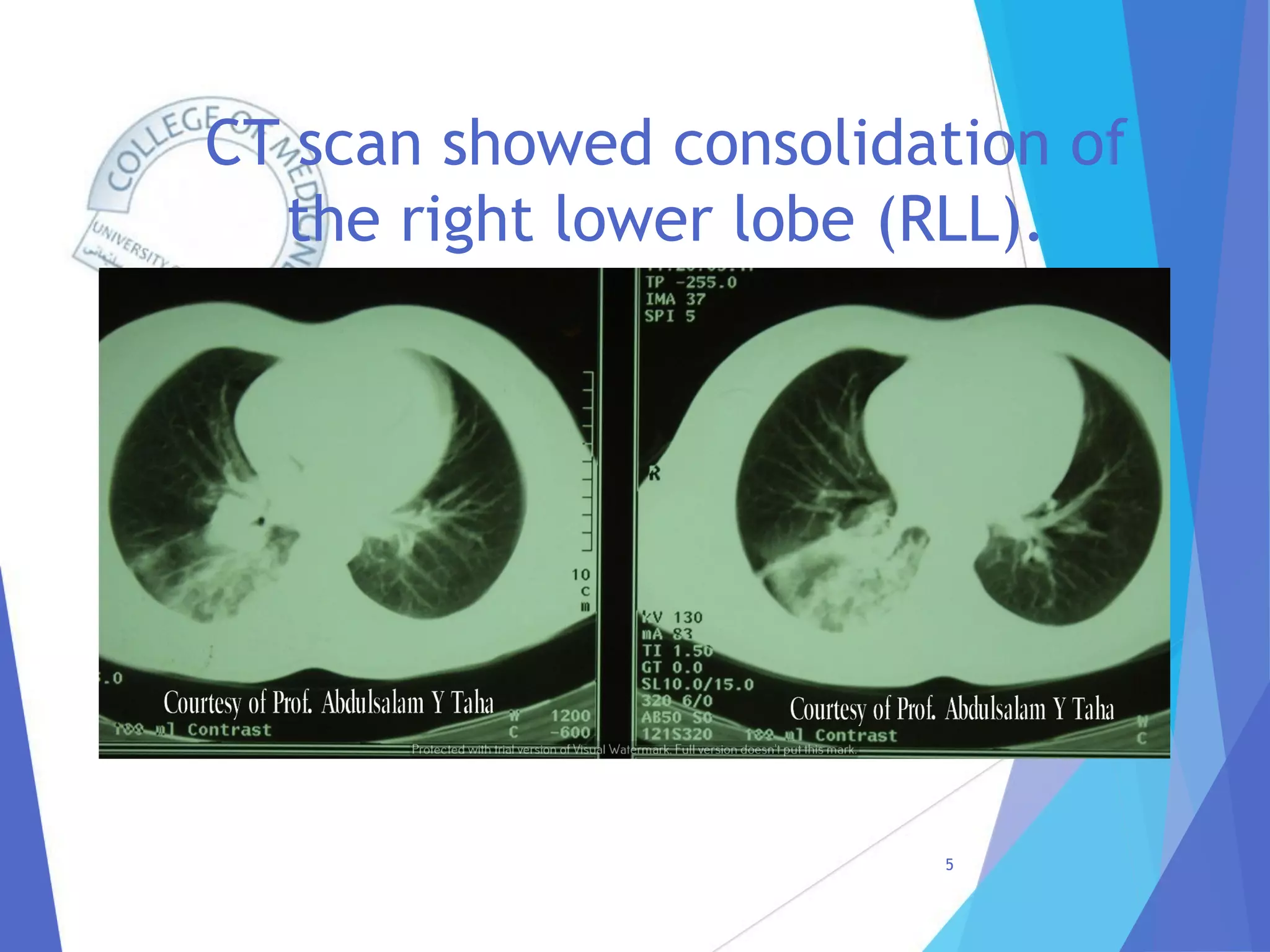 Suspected Right Lower Lobe Bronchiectasis.pdf