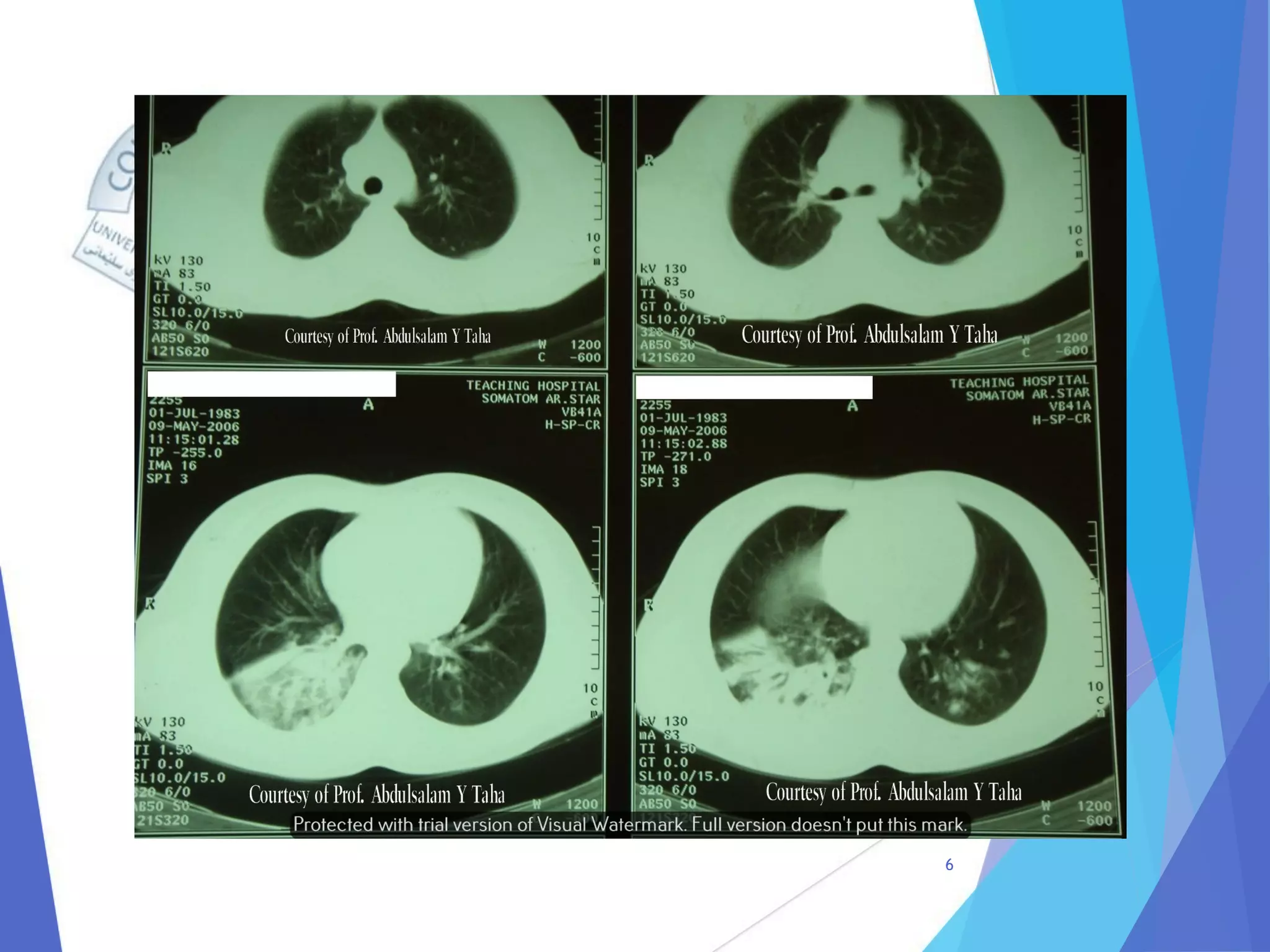 Suspected Right Lower Lobe Bronchiectasis.pdf