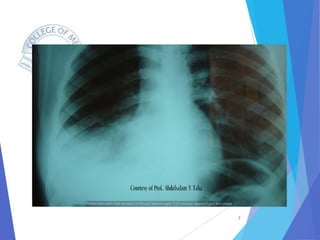 Suspected Right Lower Lobe Bronchiectasis.pdf