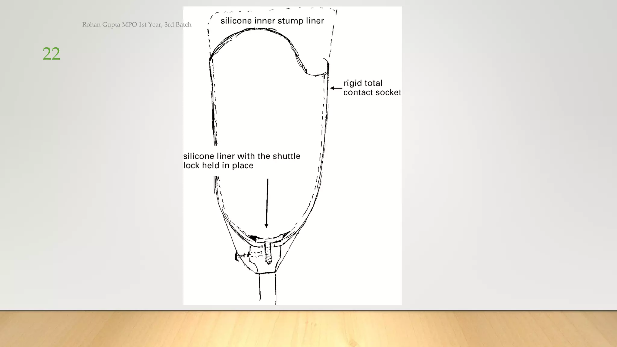 Suspension System for Transfemoral Prosthesis | PDF