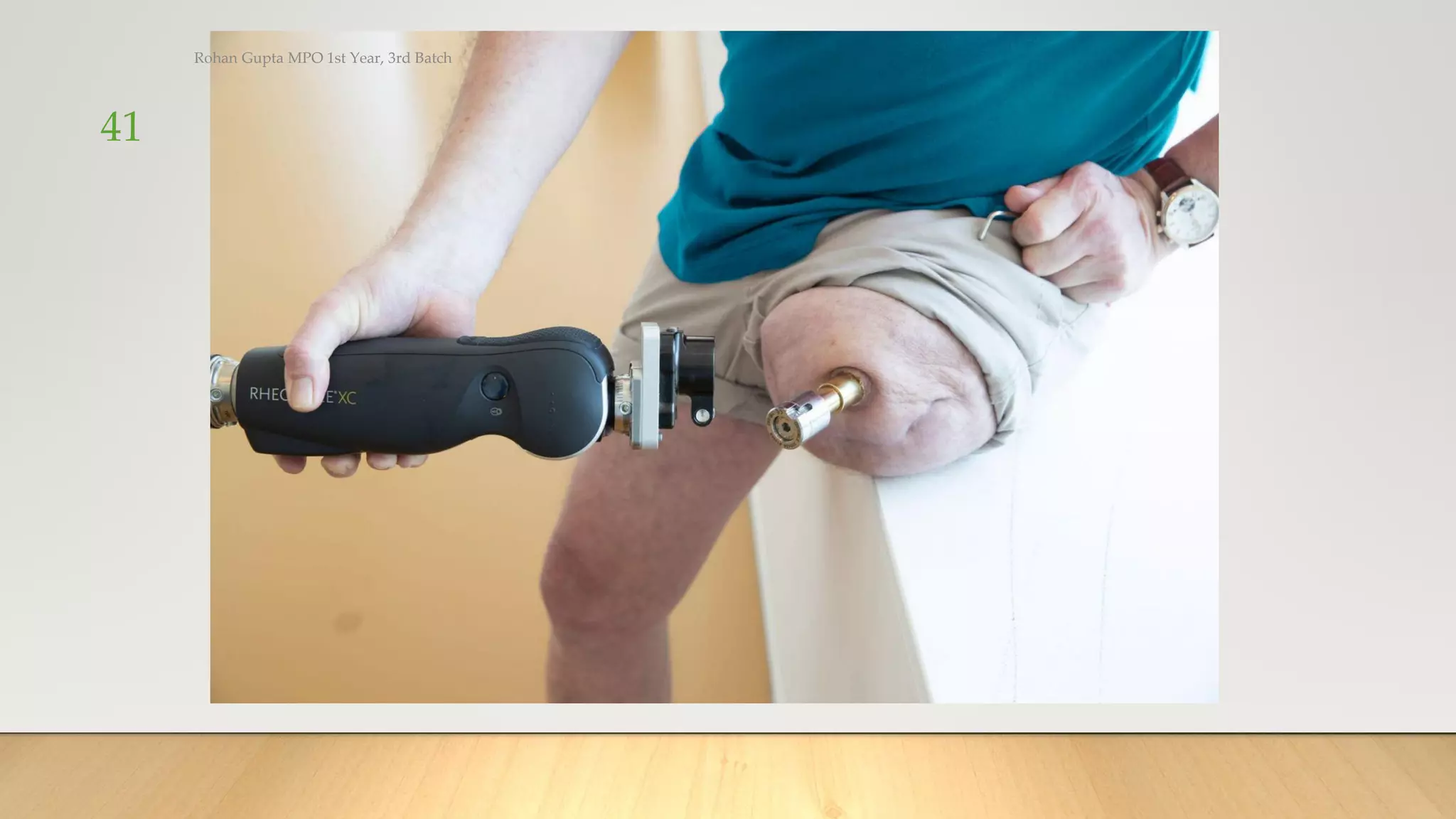 Suspension System for Transfemoral Prosthesis | PDF