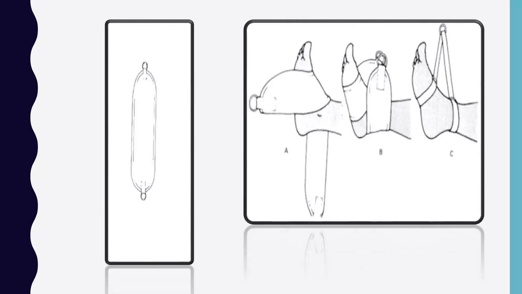 Suspension therapy | PPTX