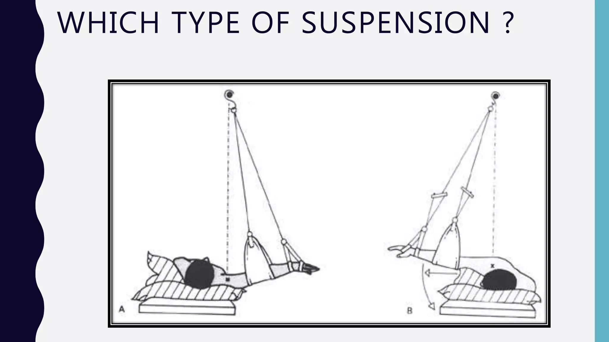 Suspension therapy | PPTX