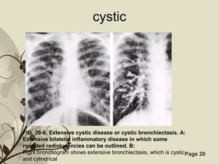 Sutton 3 bronchiectasis | PPT