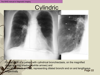 Sutton 3 bronchiectasis | PPT