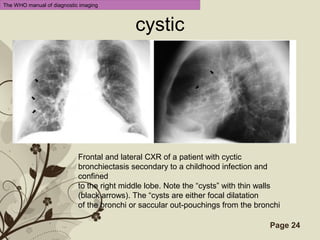Sutton 3 bronchiectasis | PPT
