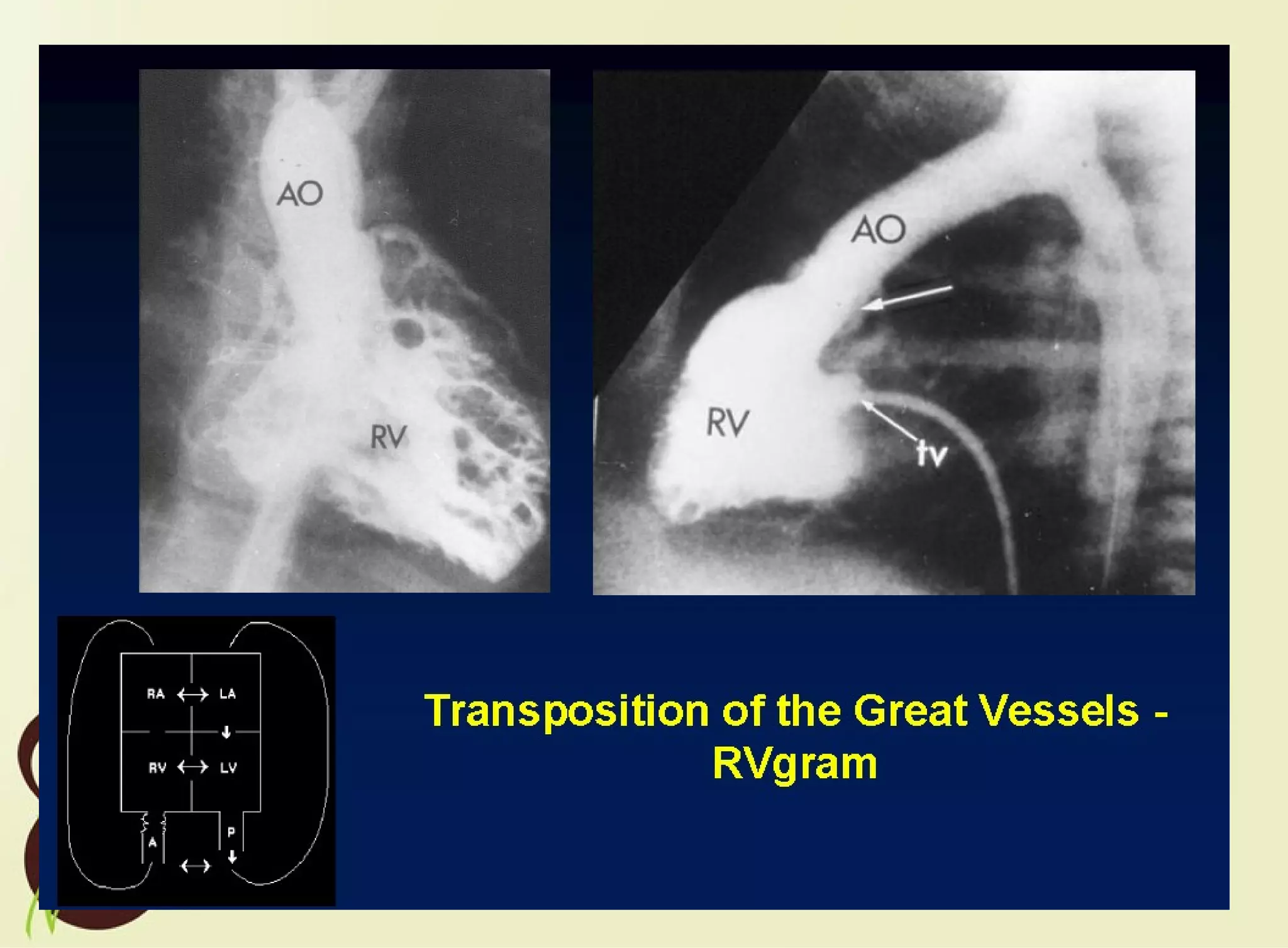 Sutton 7 transposition of the great arteries | PPT | Heart and ...