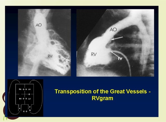 Sutton 7 transposition of the great arteries | PPT | Heart and ...