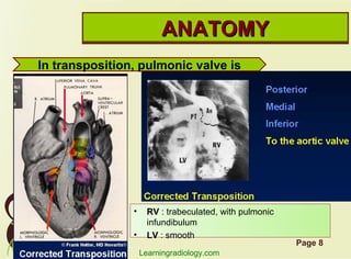 Sutton 7 transposition of the great arteries | PPT