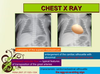 Transposition Of The Great Arteries X Ray