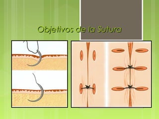 Suturas Ppt