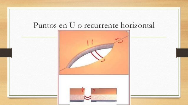 Suturas