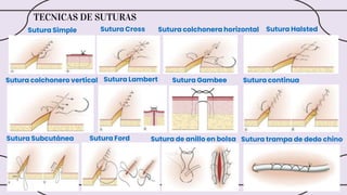 suturas.pptx