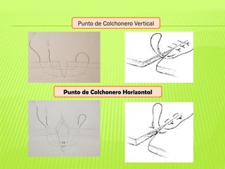 tecnicas de sutura, tipos de incisiones e hilos .pptx