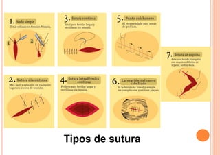 Suturas | PPTX | Surgery | Medical Health