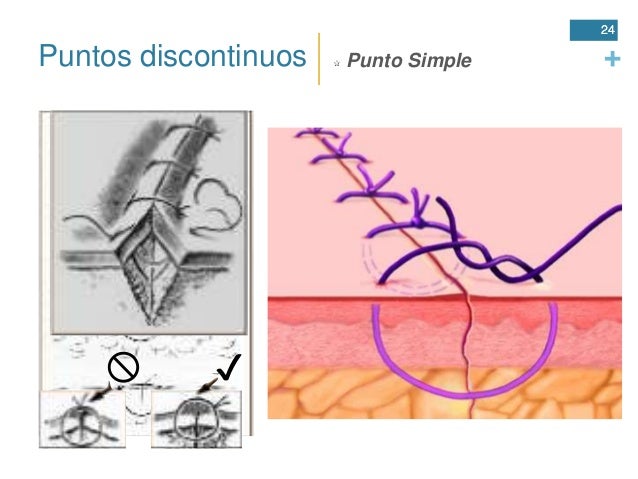Suturas Quirúrgicas