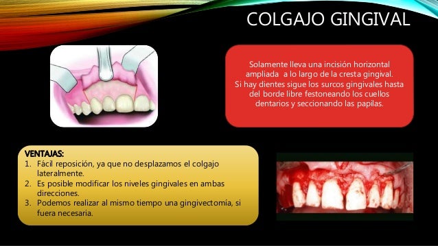 Suturas y colgajos