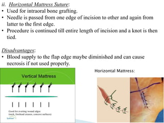 suture-170324172106.pdf Suturing techniques | PPT