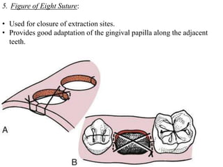 suture-170324172106.pdf Suturing techniques | PPT