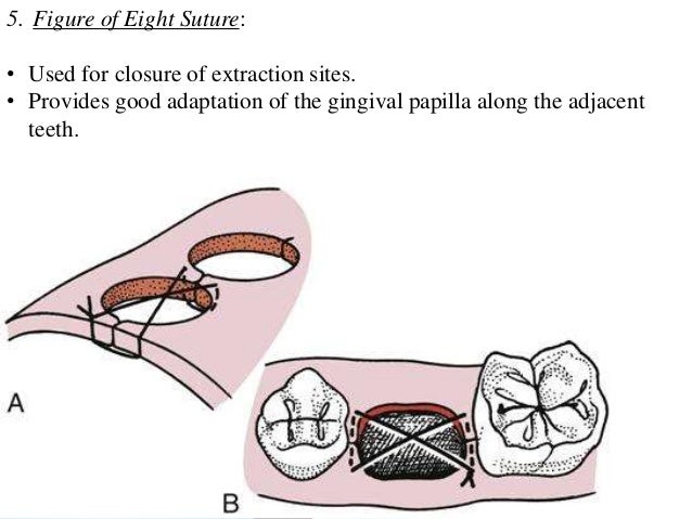 Suturing Materials and Techniques