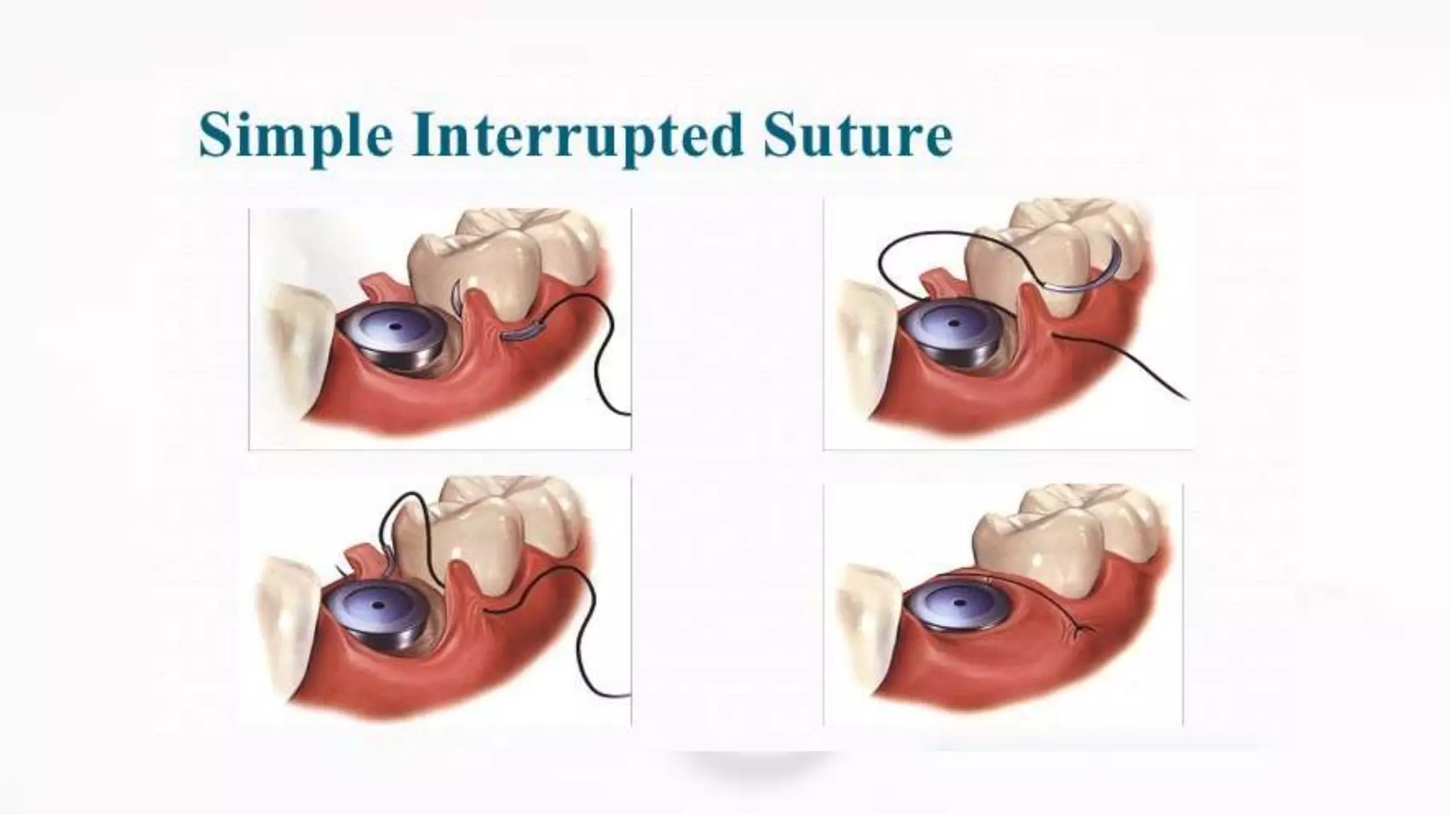 Dental Suturing: materials and techniques. | PPTX