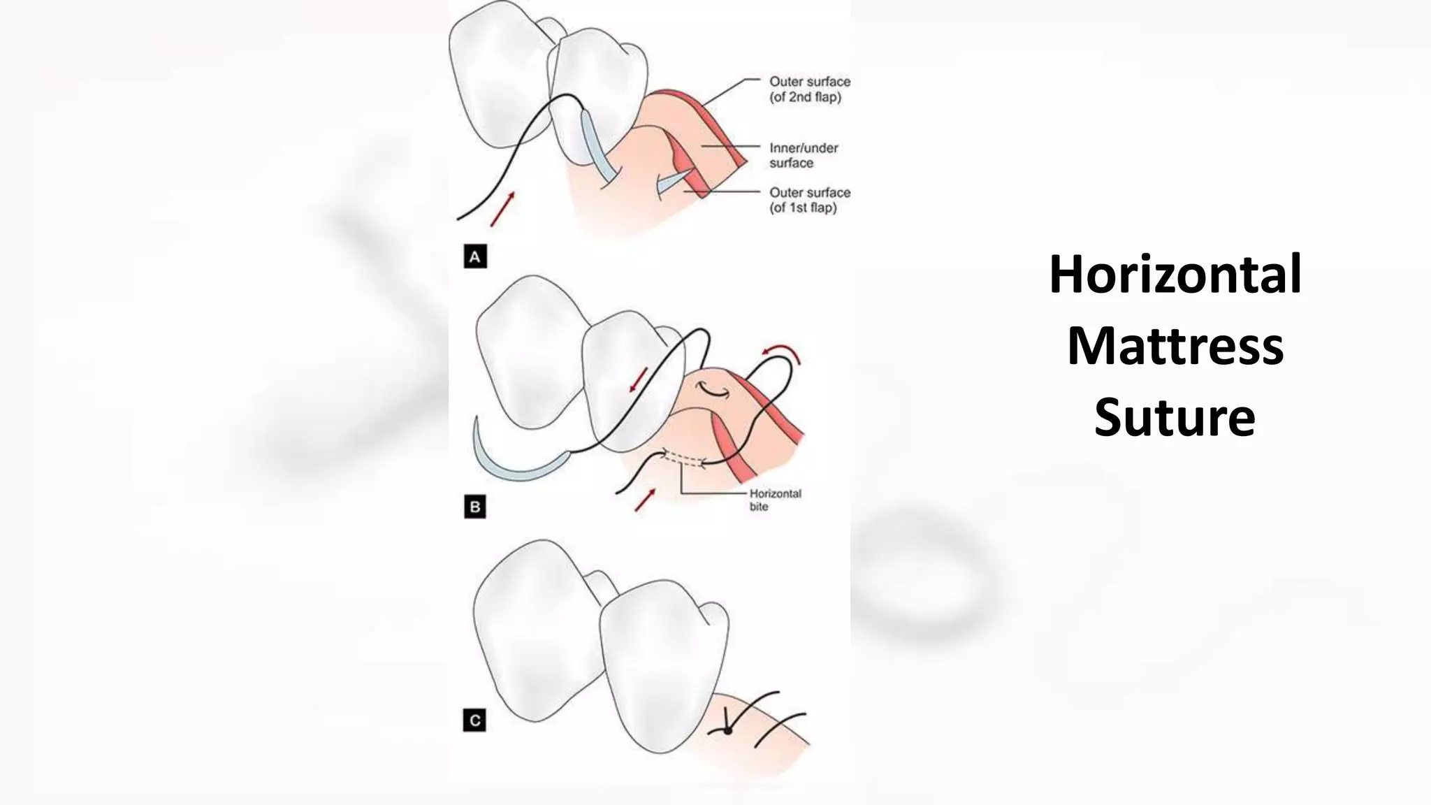 Dental Suturing: materials and techniques. | PPTX