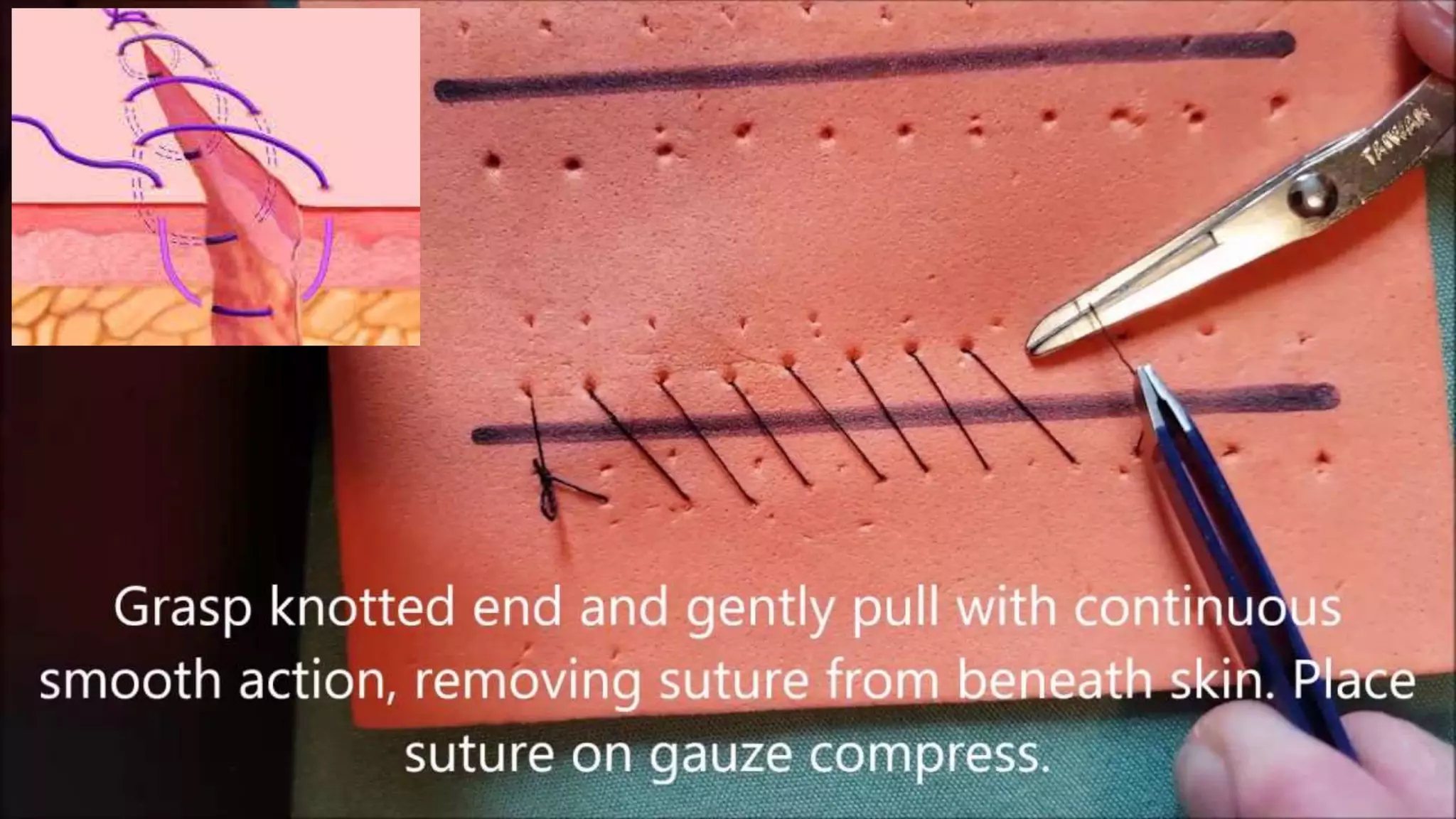 Dental Suturing: materials and techniques. | PPTX
