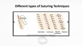 Dental Suturing: materials and techniques. | PPTX