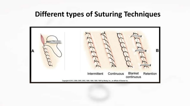 Dental Suturing: materials and techniques. | PPTX | First Aid | Injuries