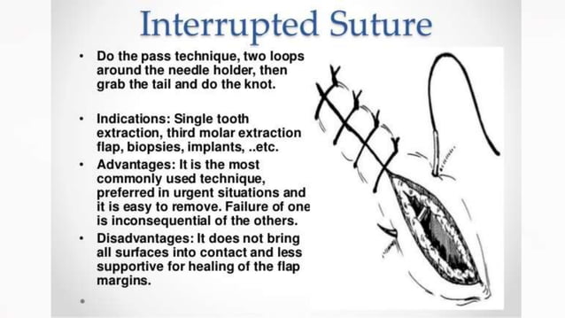 Dental Suturing: materials and techniques. | PPTX | First Aid | Injuries