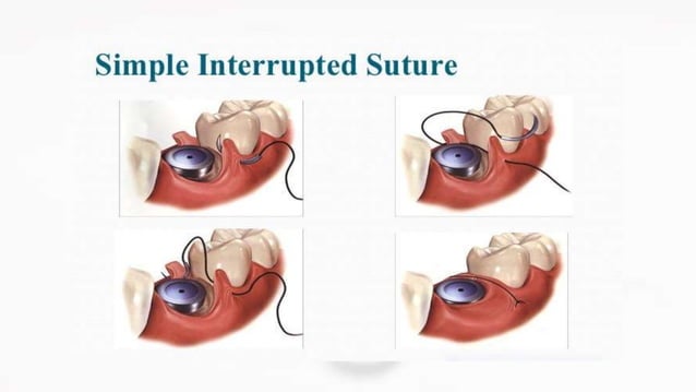 Dental Suturing: materials and techniques. | PPTX | First Aid | Injuries