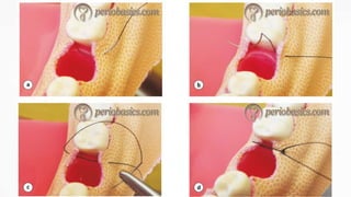 Dental Suturing: materials and techniques. | PPTX